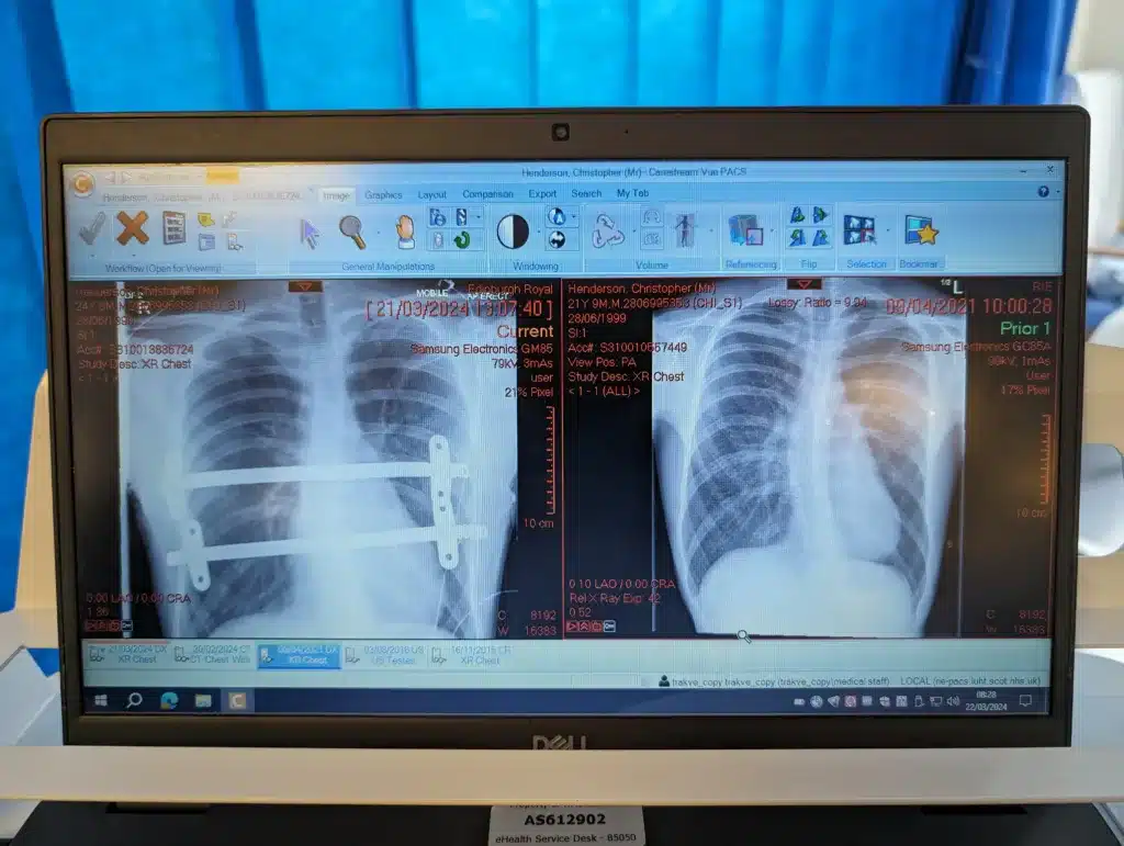 Is The Nuss Procedure Worth It? - Chris Henderson